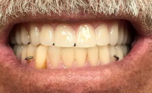 Why Do People Grind Their Teeth - Dr. Isaac Lavant